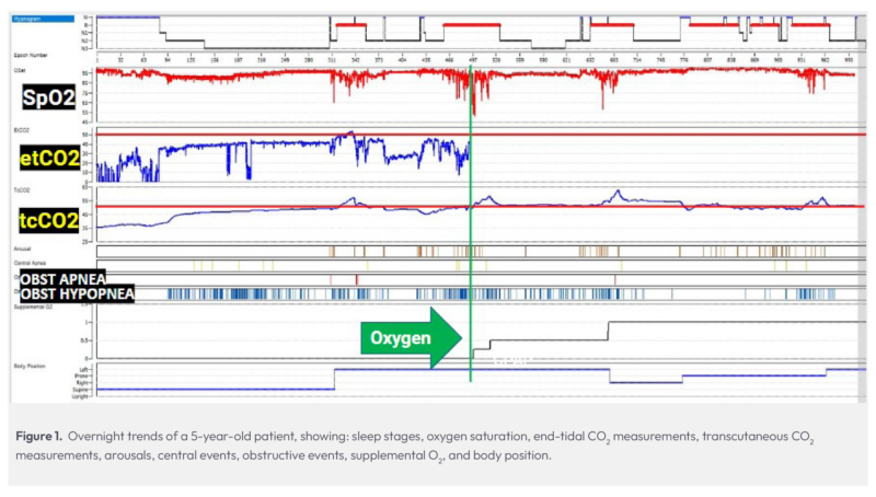 Transcutaneous CO2 Monitoring in Pediatric Sleep Studies