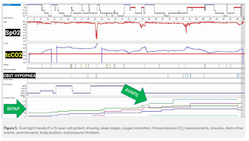 Transcutaneous CO2 Monitoring in Pediatric Sleep Studies